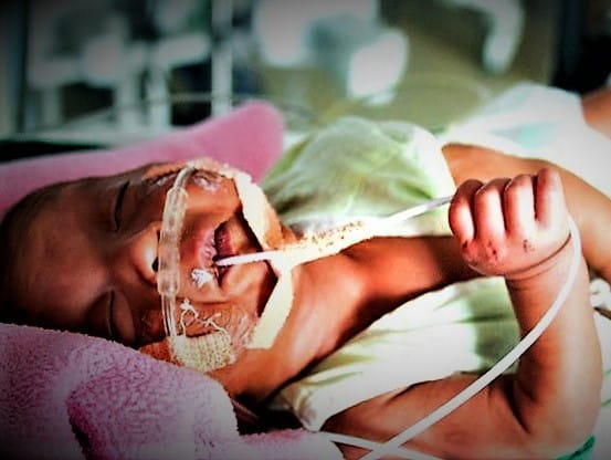 Help 15 Days old Baby Undergo Bone Marrow Transplant | Milaap
