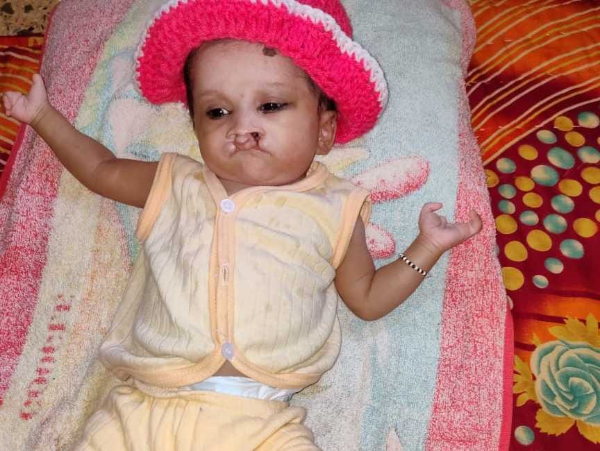 6 Months Old Asha Maurya Needs Your Help Recover From Cleft Palate